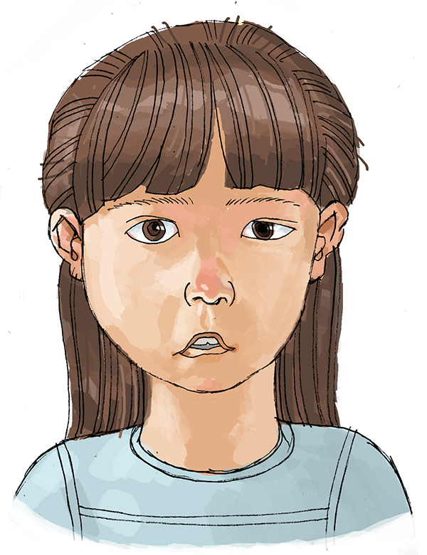 Möbius syndrome - Public_munhcenter