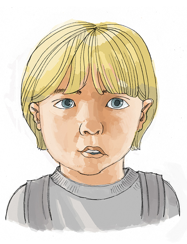 Möbius syndrome - Public_munhcenter