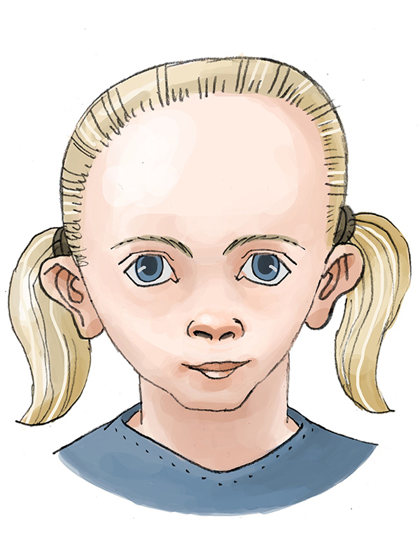 Silver-Russell syndrome - Public_munhcenter