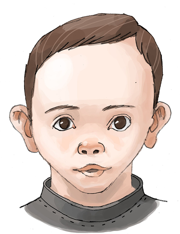 Silver-Russell syndrome - Public_munhcenter