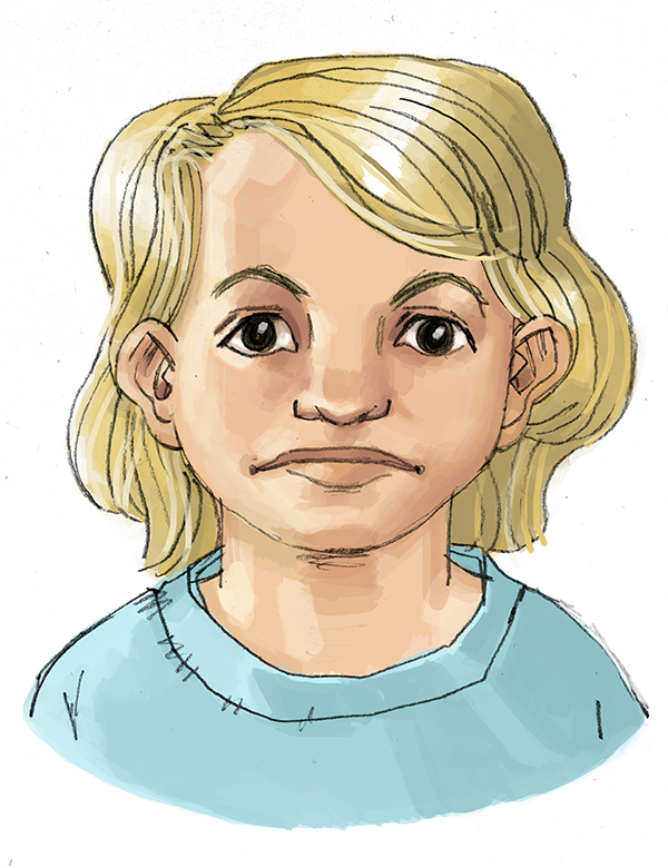 Wolf-Hirschhorn syndrome - Public_munhcenter